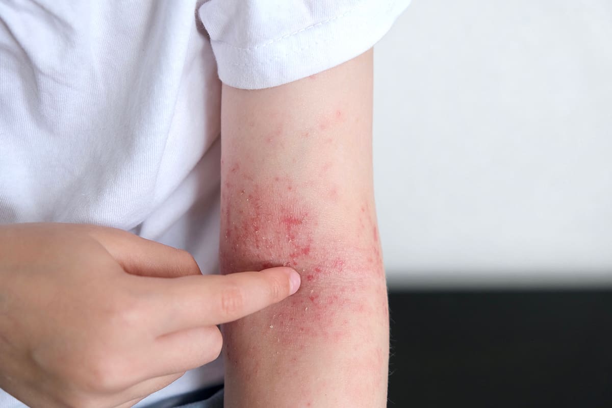 Eczema | Allergy Healthcare